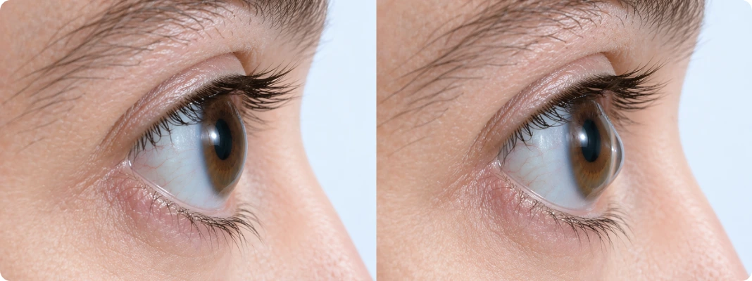 Best Contact Lenses for Keratoconus | Contacts America
